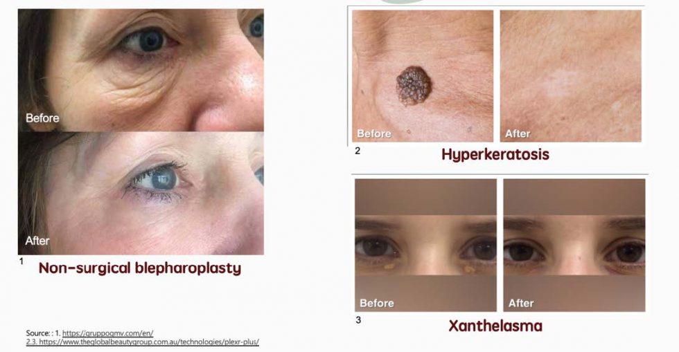 PLEXR PLUS - DSC Laser & Skin Care Center
