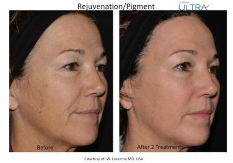 Lutronic LaseMD ULTRA Treatment Los Angeles