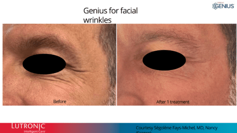 Genius RF Microneedling San Gabriel & Los Angeles CA | Lutronic Accufit