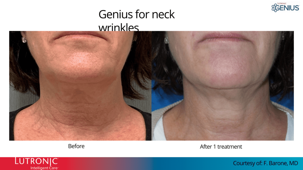Genius RF Microneedling San Gabriel & Los Angeles CA