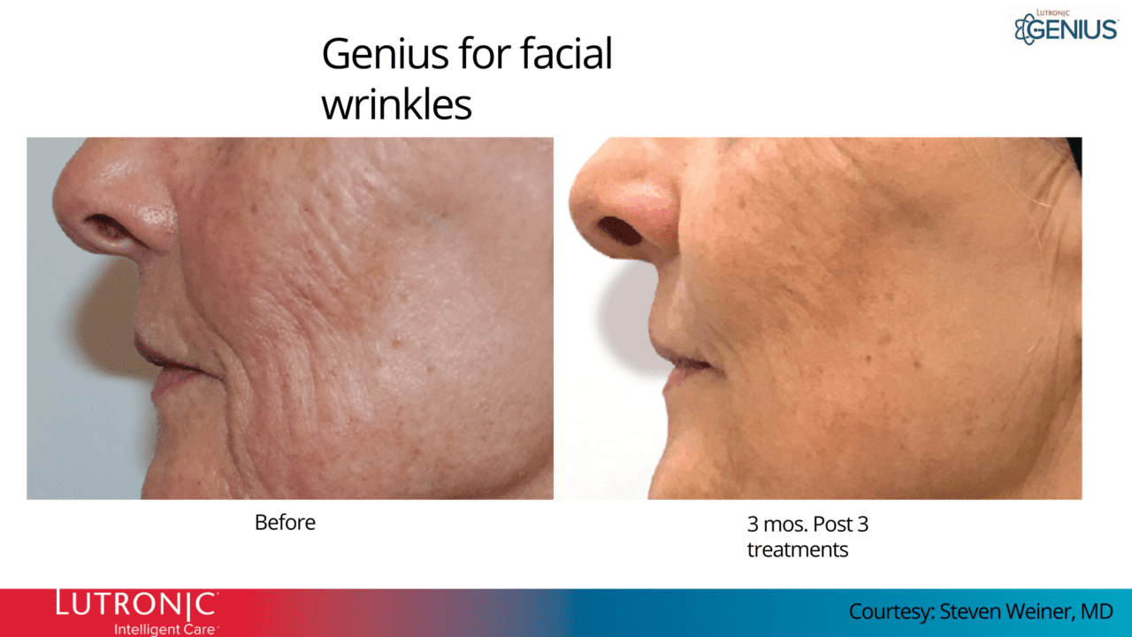 Genius RF Microneedling San Gabriel & Los Angeles CA