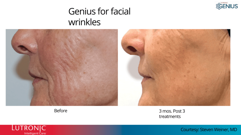 Genius RF Microneedling San Gabriel & Los Angeles CA