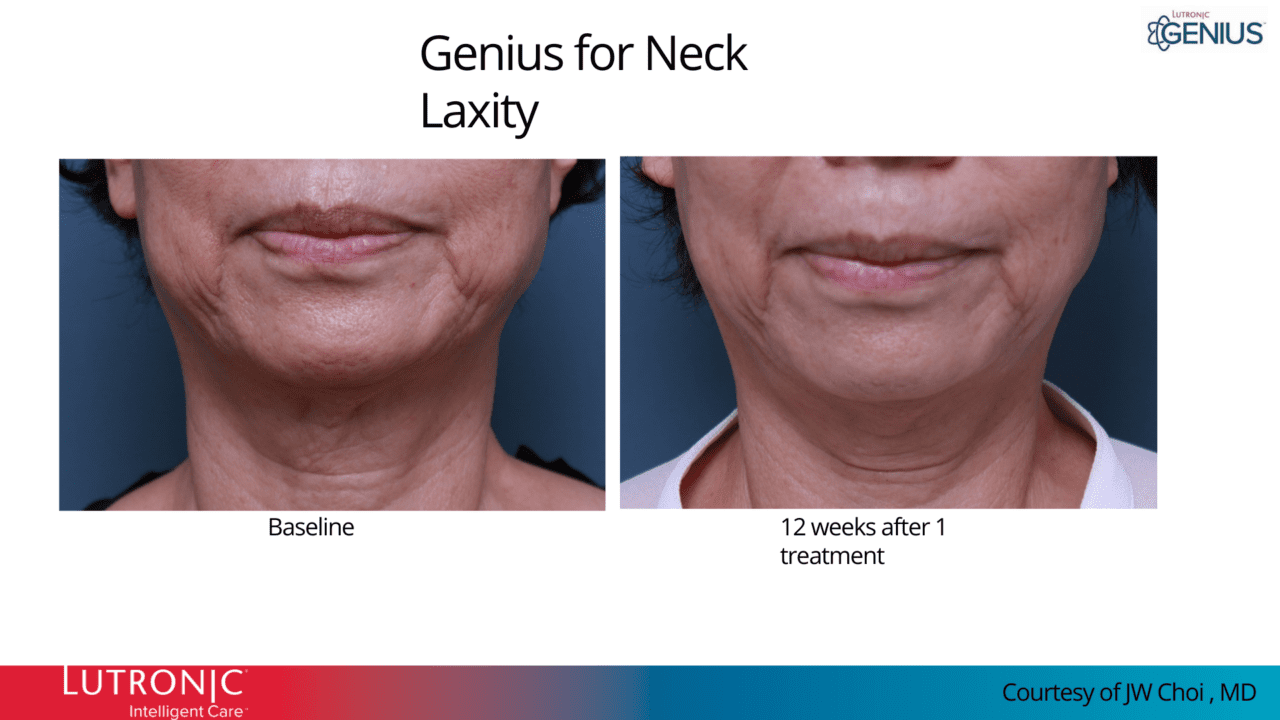 Genius RF Microneedling San Gabriel & Los Angeles CA