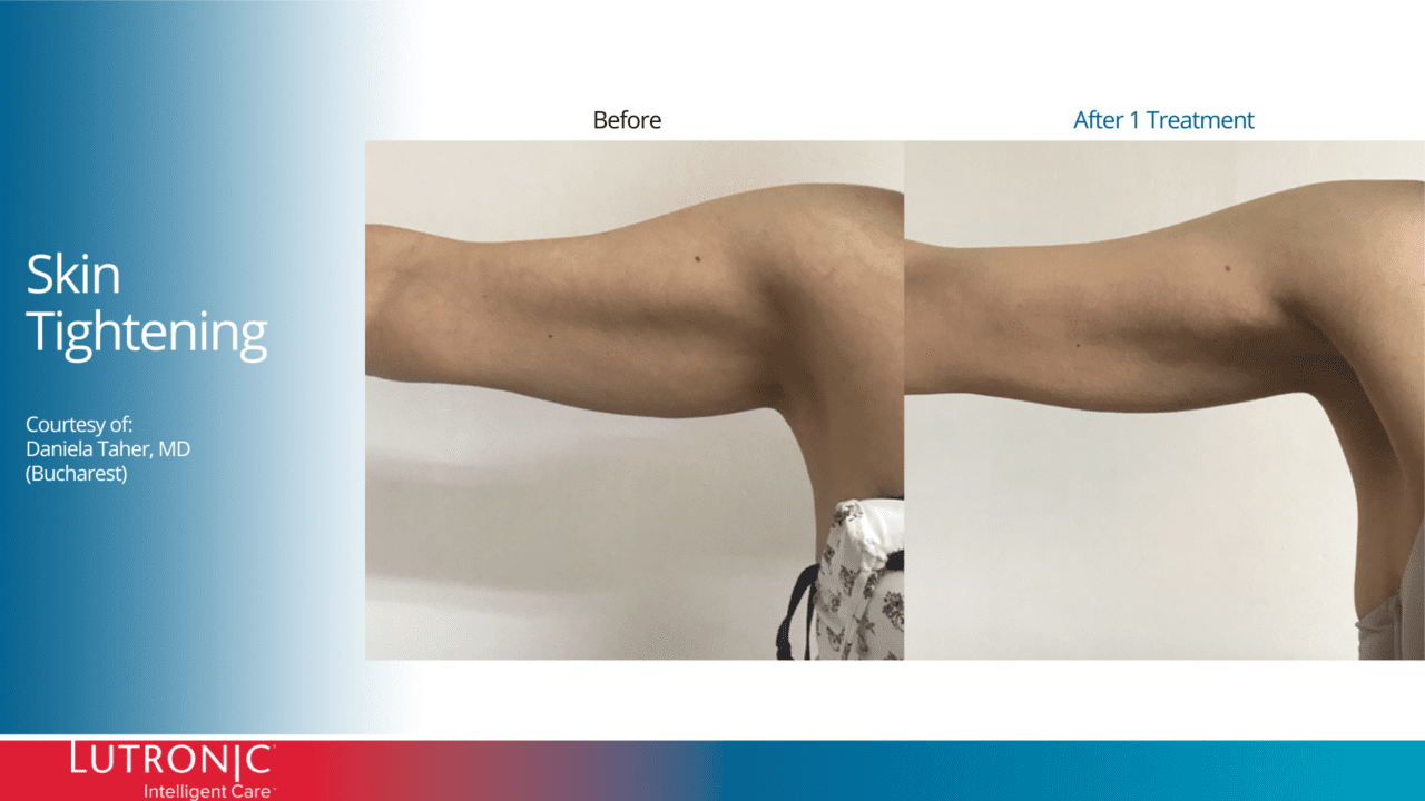 Genius RF Microneedling San Gabriel & Los Angeles CA