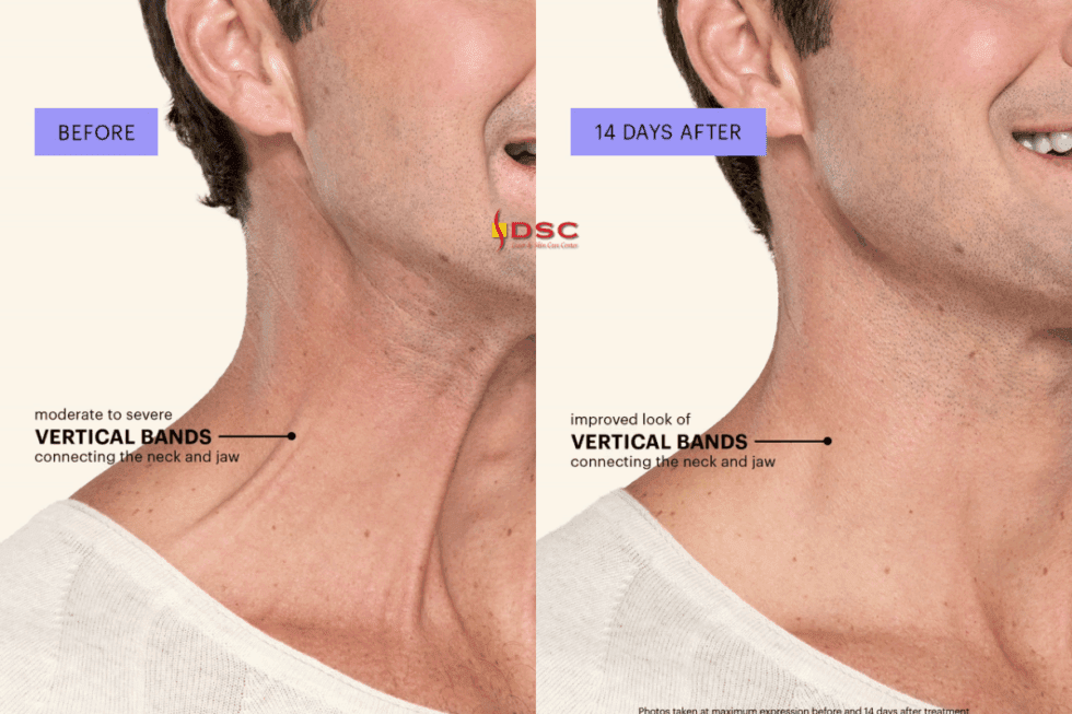 Botox for the Neck: New FDA-Indication - DSC Laser & Skin Care Center